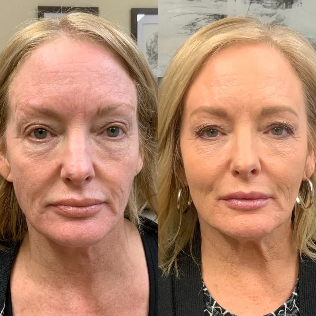 Full Facial Rejuvenation Before and After Gallery | Silk Touch